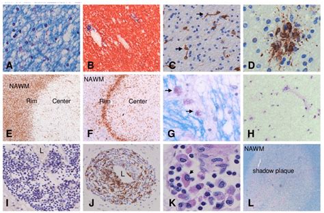 Histopathology Of Ms Normal Appearing White Matter Nawm In Ms Is Download Scientific Diagram
