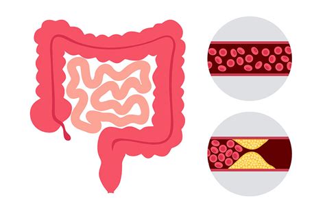 Occlusione Intestinale Cosa Fare A Bologna