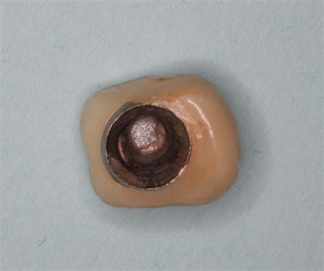 Over Contoured Implant Crown Ryan Lanman Dds Msd