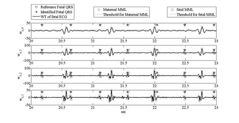 illustration of the fetal qrs detection over fetal ecg and wt