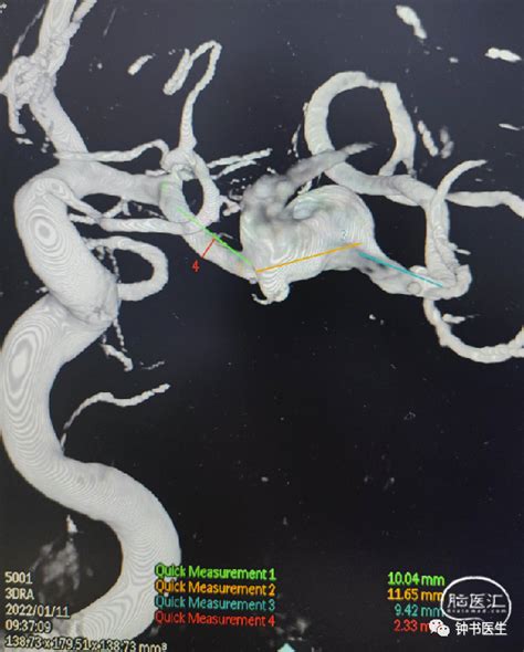 中枢介入第373期：tb治疗大脑中动脉夹层动脉瘤 脑医汇