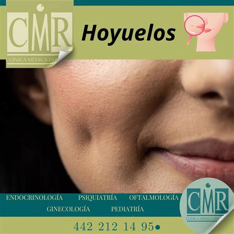Clínica ¿por Qué Algunas Personas Tienen Hoyuelos En Las Mejillas