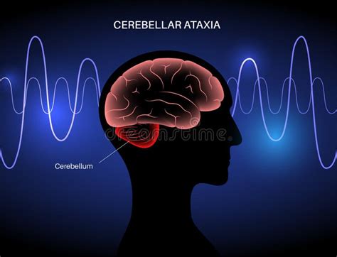 Ataxia Cerebellar Disorder Stock Vector Illustration Of Slurred