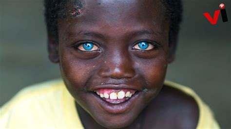 Waardenburg Syndrome