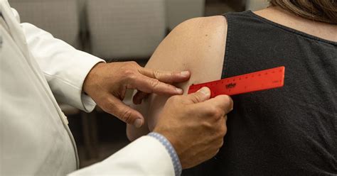 Signs Of Skin Cancer Melanoma Franks Dermatology