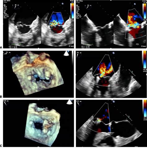 Figure 2 From Current Techniques For Severe Mitral Annular