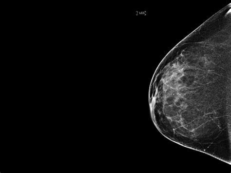 Cancer Mammogram