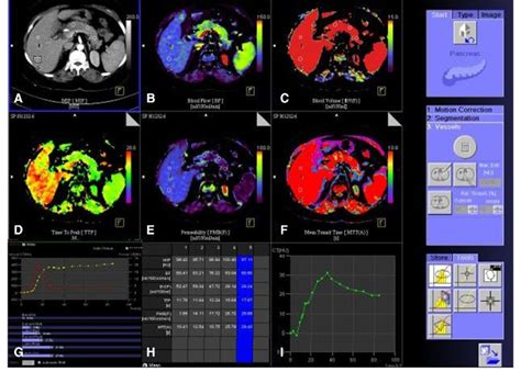 AI Perfusion Color Maps In A 52 Year Old Male In Control Group ROIs Download Scientific