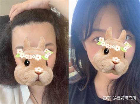 北京植发医生哪个好？手把手教你选靠谱医生 知乎