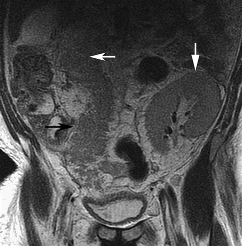 Pancreas Transplants Clinical Radiology