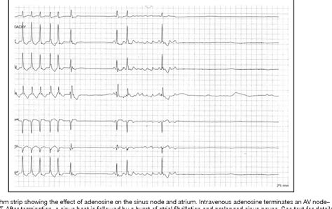 Figure 4 From Sinus Node And Atrial Arrhythmias Semantic Scholar