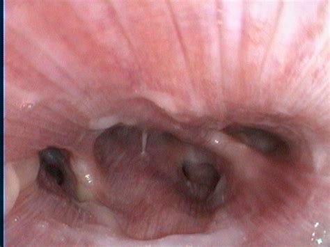 Bronchoscopy Pneumonia
