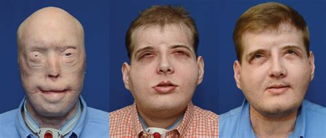 One Year Later Heroic Firefighter Who Underwent Most Extensive Face