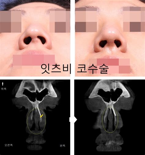 비염수술 하비갑개 절제술 의 효과와 한계 그리고 부작용 네이버 블로그