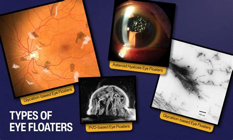 Eye Floater Types Causes Identification And Management
