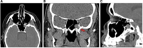 Frontiers Radiologic Overview Of Sinonasal Lesions
