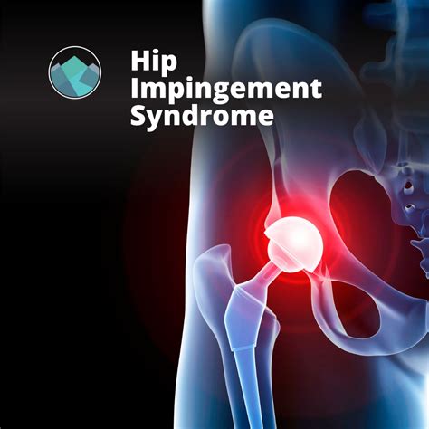 How Hip Impingement Syndrome Affects Hip Joints Connected Whole