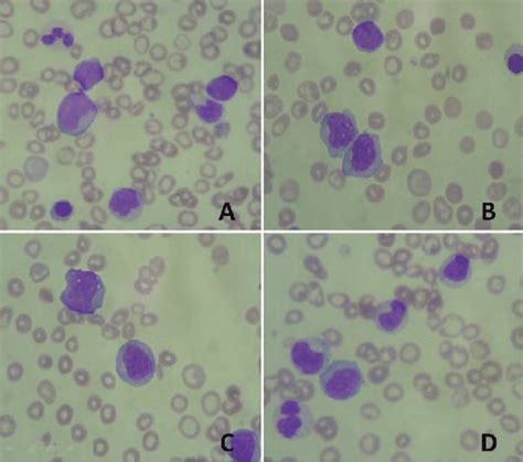 A Presence Of Blastic Cells In Peripheral Blood B And Cvacuolated