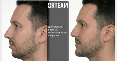 Дистальный прикус как выдвинуть нижнюю челюсть 5 вариантов лечения