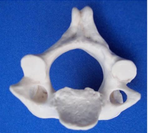 Cervical Axis Vertebrae Diagram Quizlet