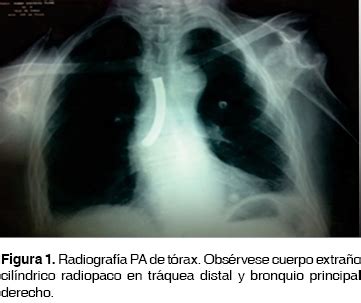 Extracción de cánula de traqueostomía broncoaspirada a la vía aérea