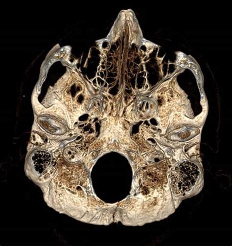 Three‐dimensional Reconstruction Showing An Occipital Fracture With Download Scientific Diagram