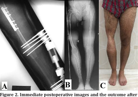 Figure 2 From Lower Limb Reconstruction Using Tibial Strut Autograft