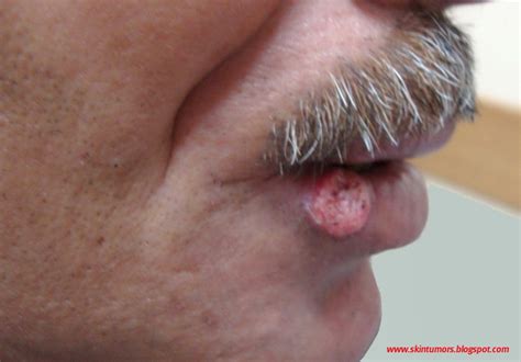 Skin Tumors Keratoacanthoma