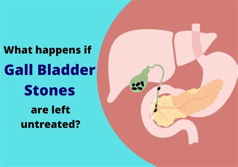 Gall Bladder Stone Symptoms