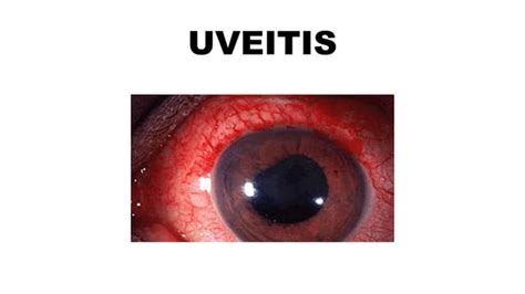 Uveitis Exam Reference Notes Importantpptx