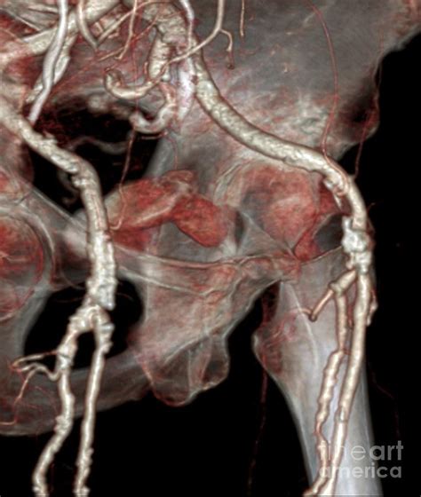 Atherosclerosis 3d Ct Scan Photograph By Zephyr Fine Art America