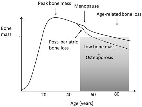Age Related Loss Of Bone Mass In Women Schematic In Both Women And