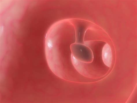 Colon Polyps Palmer General Surgeon Mat Su Surgical Associates Apc