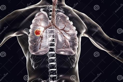 Fibrous Cavernous Pulmonary Tuberculosis Stock Illustration Illustration Of Caverna Epidemic