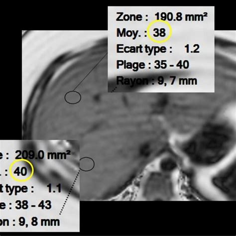 Caudate Lobe Hypertrophy Non Enhanced Axial Ct Scan Image Of The