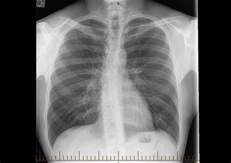 Pulmonary Fibrosis Diagnosis And Treatment Lung And Sleep
