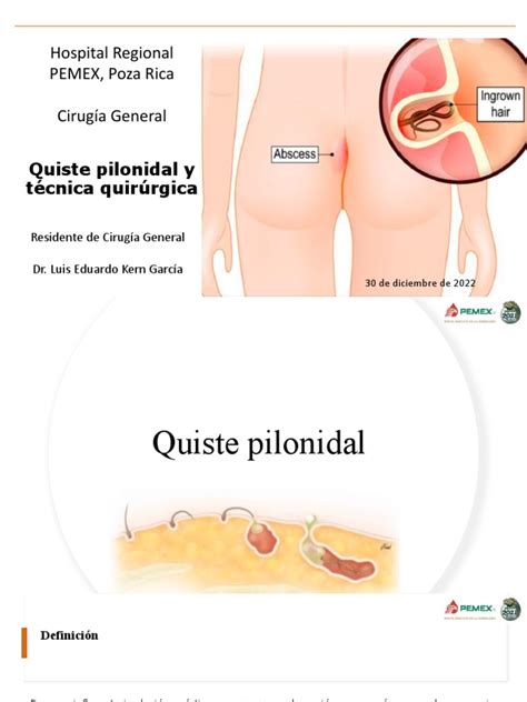 Quiste Pilonidal Luis Eduardo Kern García Pdf Diagnostico Medico