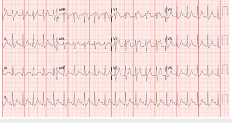 Initial Electrocardiogram Obtained Upon Arrival To The Emergency