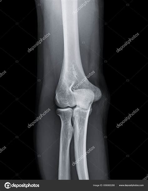 Radiografía De Anatomía Del Codo