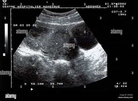 Fibrome utérin l échographie Photo Stock Alamy
