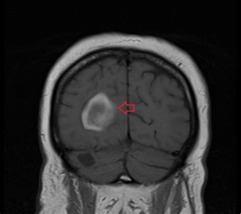 Mri Pathology Images Pathologies Mri Brain Pathology In 2025 Mri Brain Brain Mri
