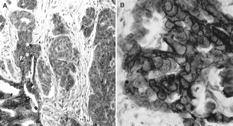 Immunohistochemical Labelling Results With Anti Egfr Antibody A