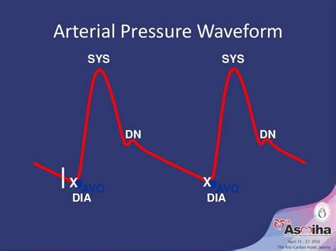 Iabp Principle Hemodynamic Timing Weaning 2016 Background Asmiha
