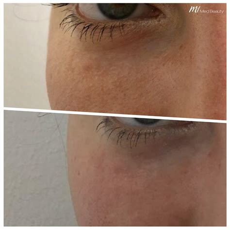 Tear Trough Filler Under Eye Filler M1 Med Beauty London Liverpool