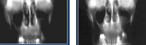 Extraoral Radiography Flashcards Quizlet
