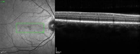Paracentral Acute Middle Maculopathy Pamm R Ophthalmicphotogs