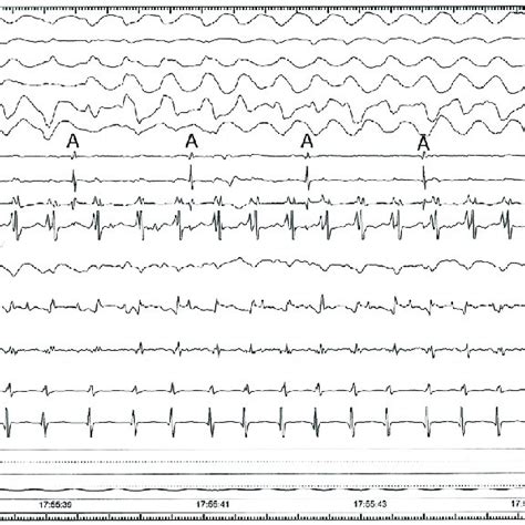 Spontaneous Termination Of Ventricular Fibrillation After The Ablation Download Scientific