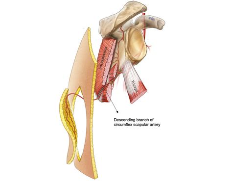 Schematic Diagram Demonstrating The Anatomy Of The Parascapular Flap