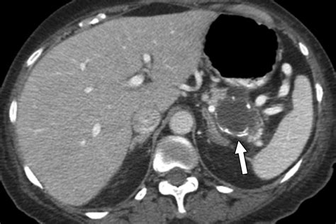 Pancreatic Calcifications And Calcified Pancreatic Masses Pattern