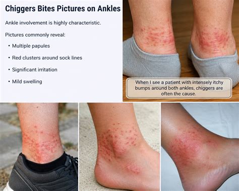 Chiggers Bites Pictures What Chigger Bites Look Like Symptoms